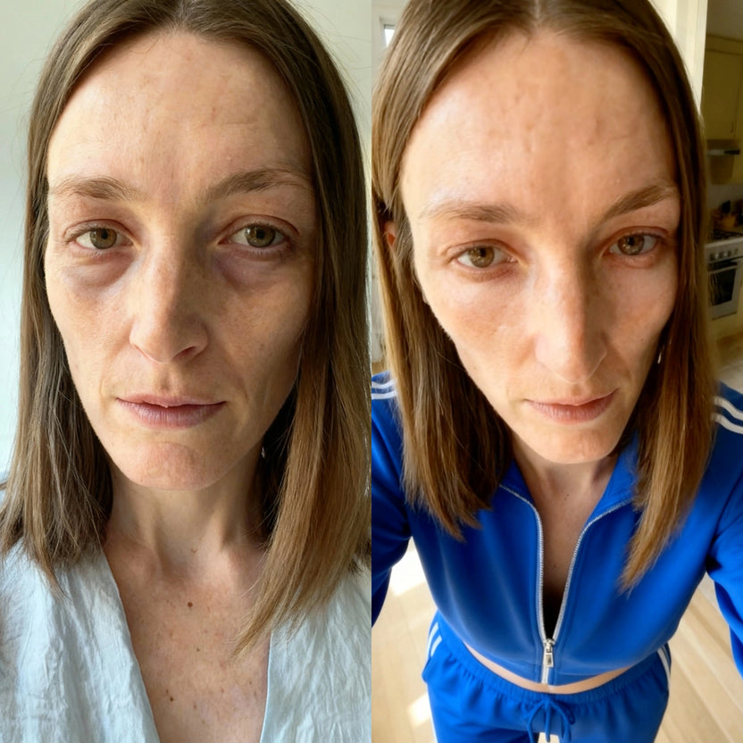 Non-Surgical Tear Trough Treatment for Brighter, Fuller Under Eyes ...