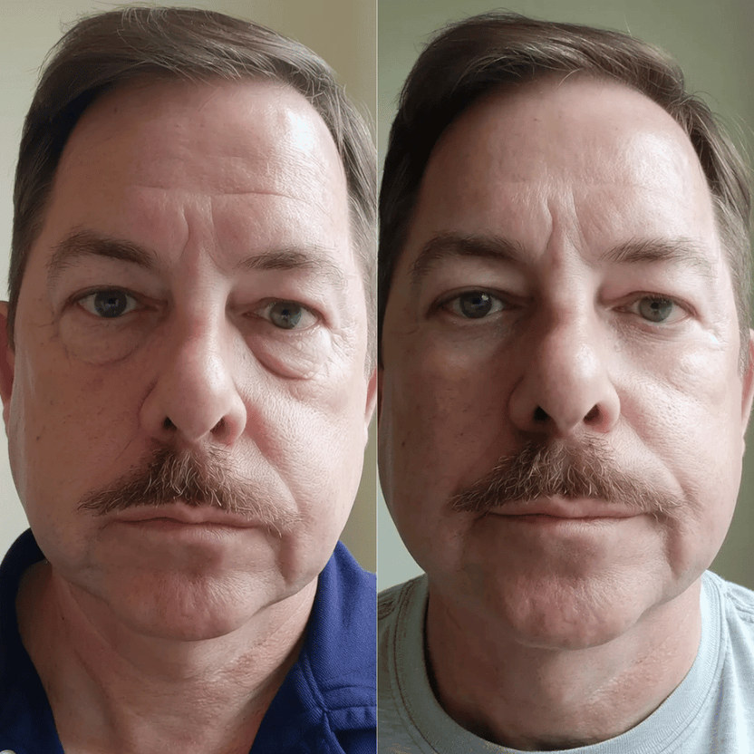 Fastest Proven Way to Remove Under Eye Bags Without Surgery For Men ...