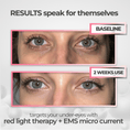 RevitalEyes™ 2-in-1 Red Light + EMS Under-Eye Therapy – Botanique Paris