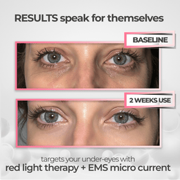 RevitalEyes™ 2-in-1 Red Light + EMS Under-Eye Therapy – Botanique Paris